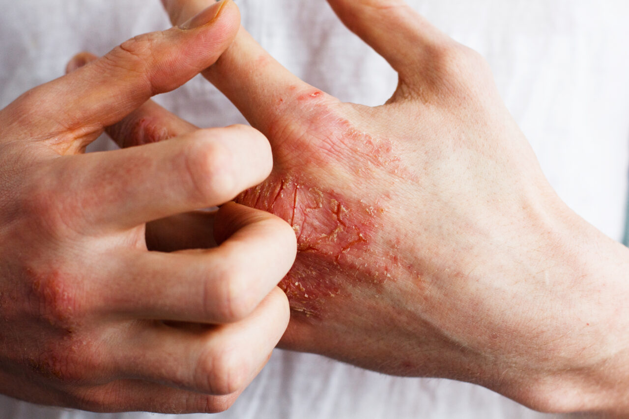 Psoriasis - Premier Dermatology Group | Dermatology
