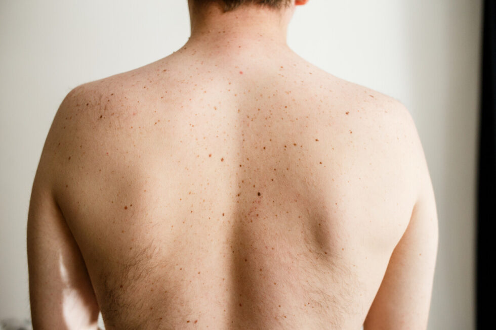 Electronic Brachytherapy for Non-Melanoma Skin Cancer - Premier ...